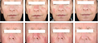 Support for your patients who use LEVULAN® KERASTICK® (aminolevulinic ...