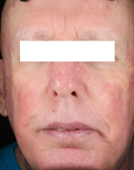 Proven AK Treatment Results for LEVULAN® | LEVULAN® KERASTICK ...