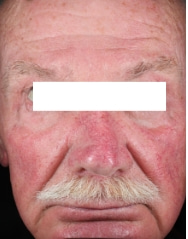 Proven AK Treatment Results for LEVULAN® | LEVULAN® KERASTICK ...