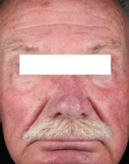 Proven AK Treatment Results for LEVULAN® | LEVULAN® KERASTICK ...