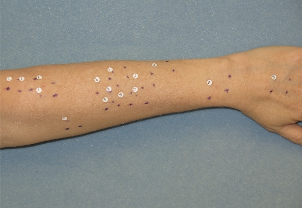 Proven AK Treatment Results for LEVULAN® | LEVULAN® KERASTICK ...