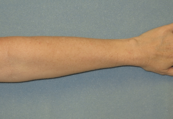 Proven AK Treatment Results for LEVULAN® | LEVULAN® KERASTICK ...