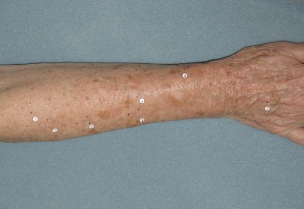 Proven AK Treatment Results for LEVULAN® | LEVULAN® KERASTICK ...