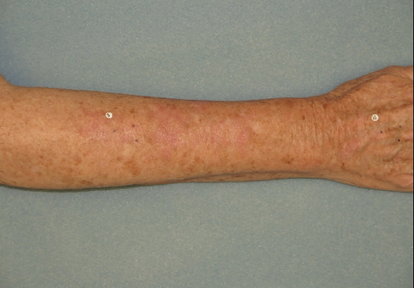 Proven AK Treatment Results for LEVULAN® | LEVULAN® KERASTICK ...