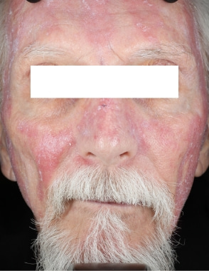 Proven AK Treatment Results for LEVULAN® | LEVULAN® KERASTICK ...