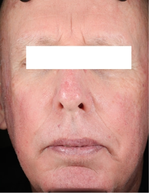 Proven AK Treatment Results for LEVULAN® | LEVULAN® KERASTICK ...