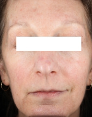 Proven AK Treatment Results for LEVULAN® | LEVULAN® KERASTICK ...