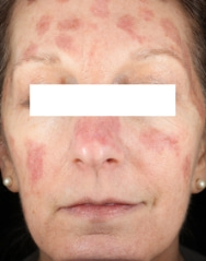 Proven AK Treatment Results for LEVULAN® | LEVULAN® KERASTICK ...