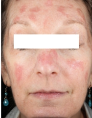 Proven AK Treatment Results for LEVULAN® | LEVULAN® KERASTICK ...